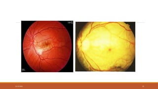 OCULAR CIRCULATION, arterial supply and venous drainage of the eye.pptx