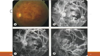OCULAR CIRCULATION, arterial supply and venous drainage of the eye.pptx