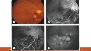 OCULAR CIRCULATION, arterial supply and venous drainage of the eye.pptx