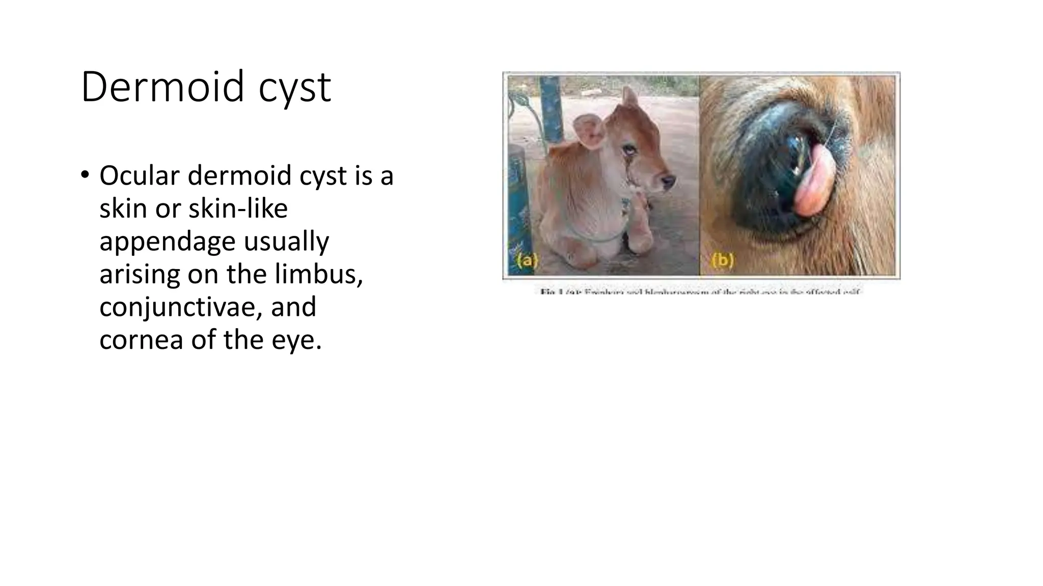 Ocular dermoid cyst.pdf
