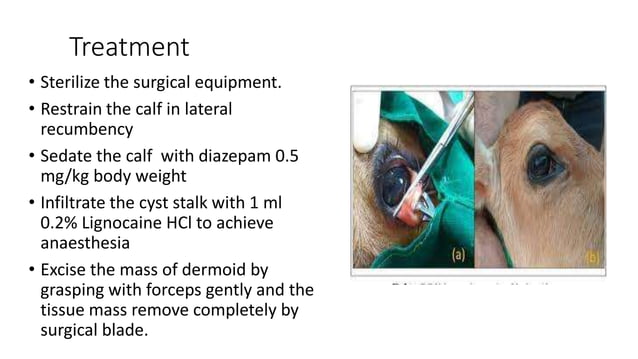 Ocular dermoid cyst.pdf