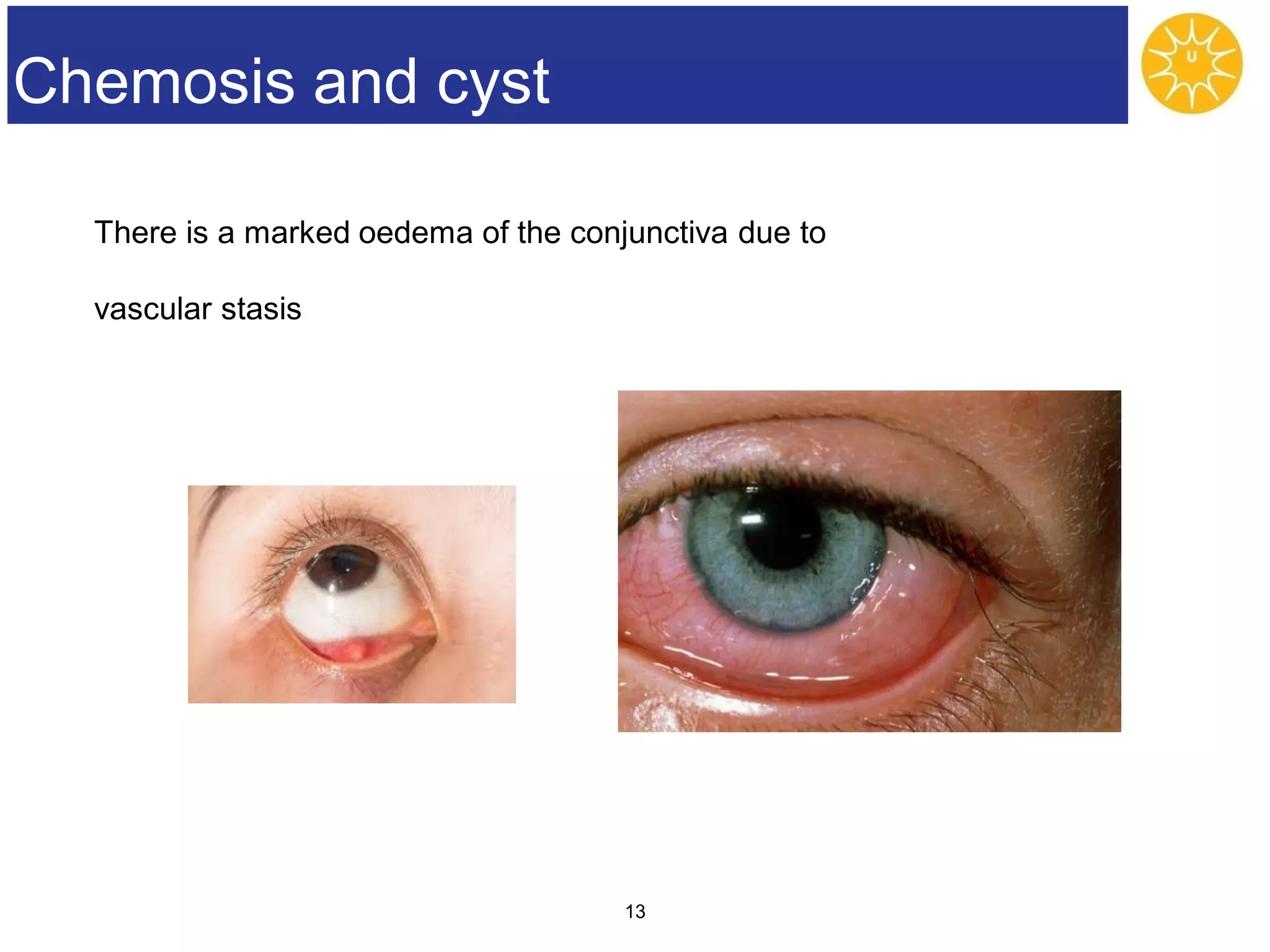 Ocular diseases.ppt