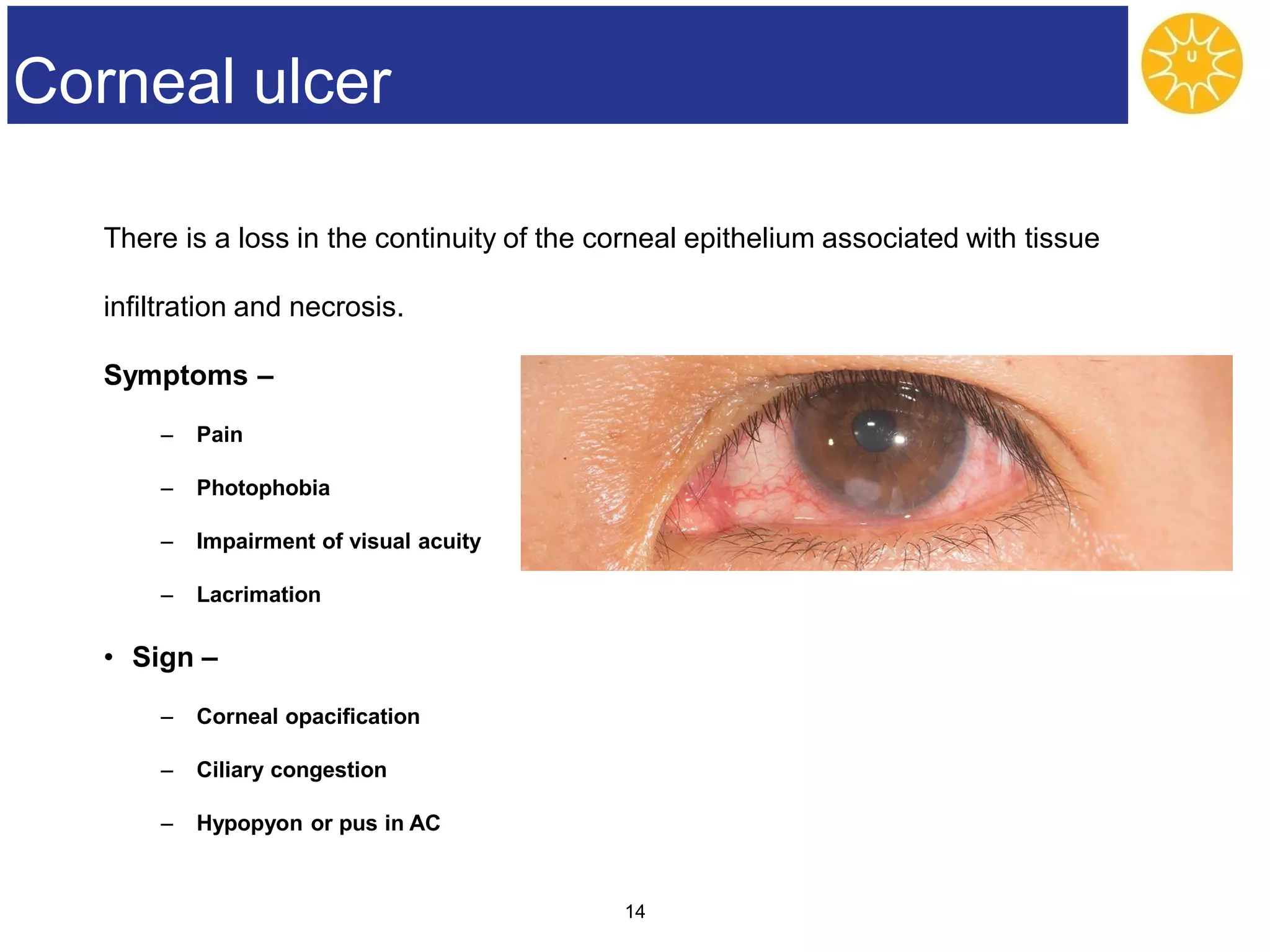 Ocular diseases.ppt