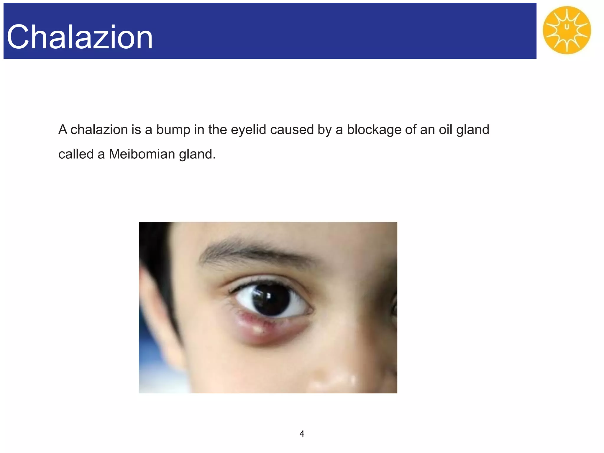 Ocular diseases.ppt