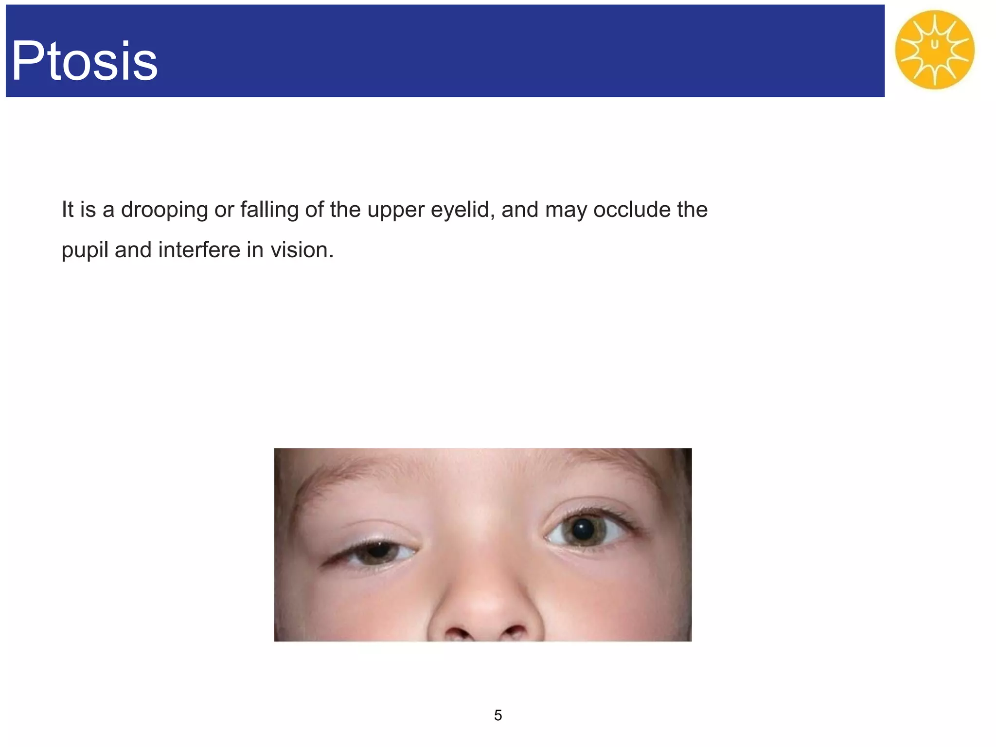 Ocular diseases.ppt