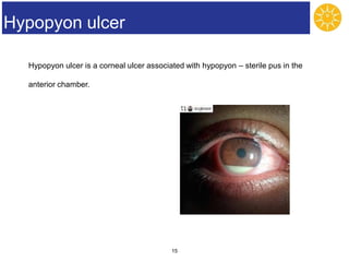 Ocular diseases.ppt