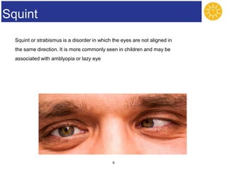 Ocular diseases.ppt