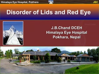 Ocular disorder | PPT