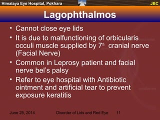 Ocular disorder | PPT