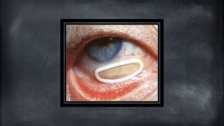 Ocular drug delivery | PPTX | Eye and Vision Conditions | Diseases and ...