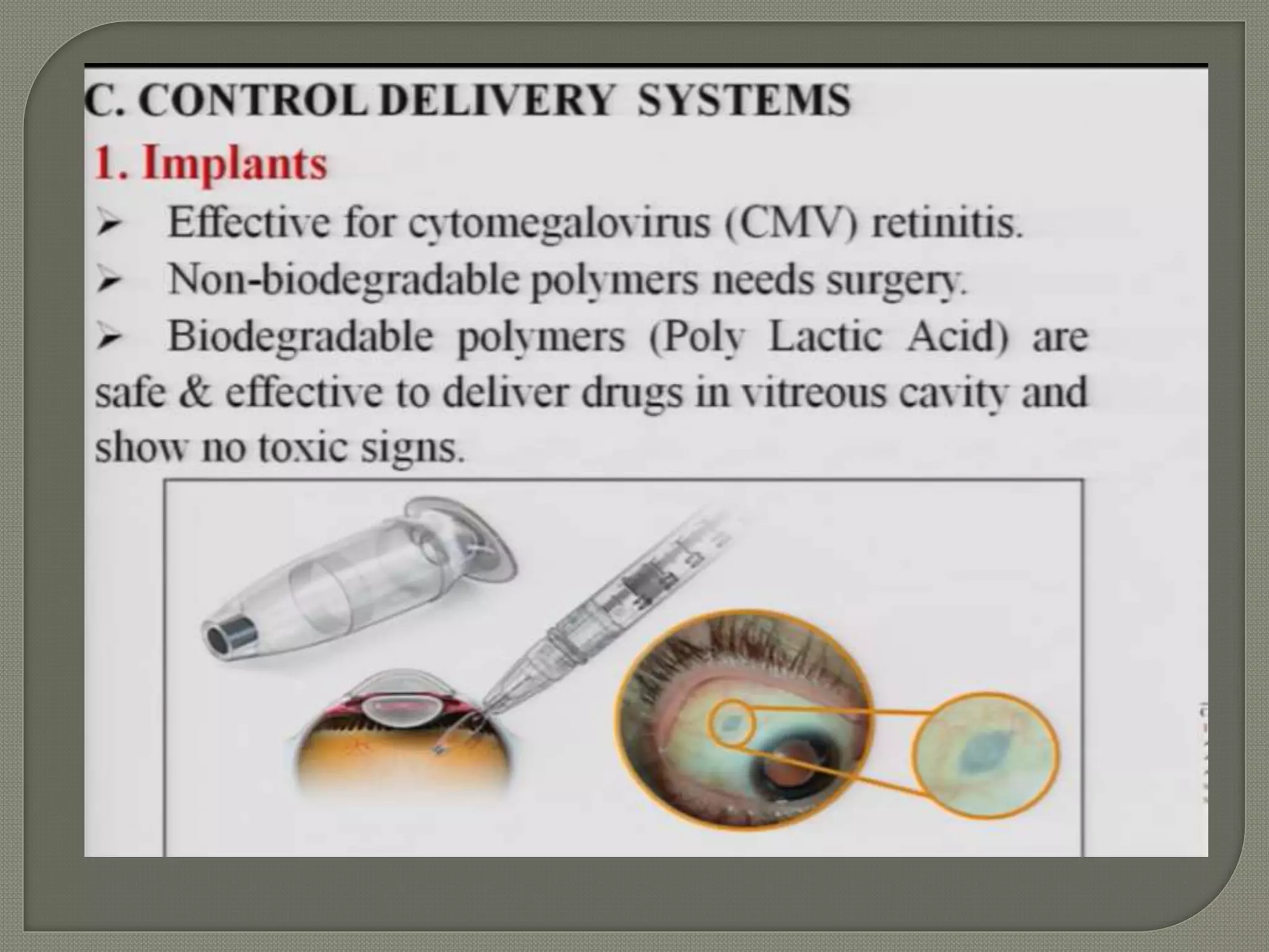 OCULAR DRUG DELIVERY SYSTEM.pptx