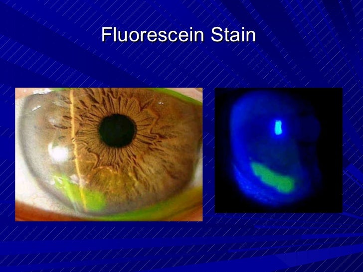 Ocularemerg Ocularemerg