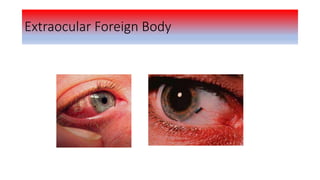 Ocular emergencies | PPTX