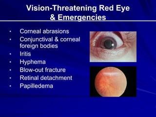 Ocular emergencies.ppt