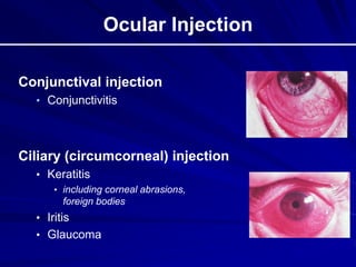 Ocular emergencies.ppt