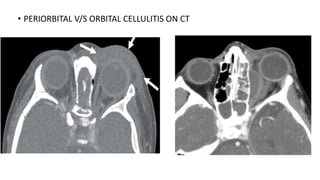 OCULAR EMERGENCIES IN PEDIATRICS [Autosaved].pptx