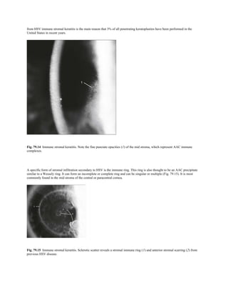 Ocular manifestaions of HSV infection by Qutaiba Alnahi | PDF