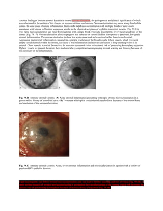Ocular manifestaions of HSV infection by Qutaiba Alnahi | PDF | Free ...