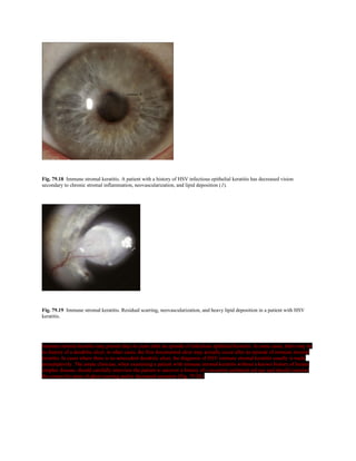 Ocular manifestaions of HSV infection by Qutaiba Alnahi | PDF