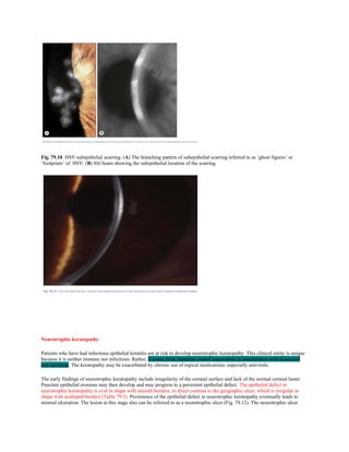 Ocular manifestaions of HSV infection by Qutaiba Alnahi | PDF