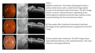 Ocular infection in AIDS | PPTX