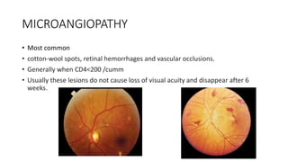 Ocular infection in AIDS | PPTX
