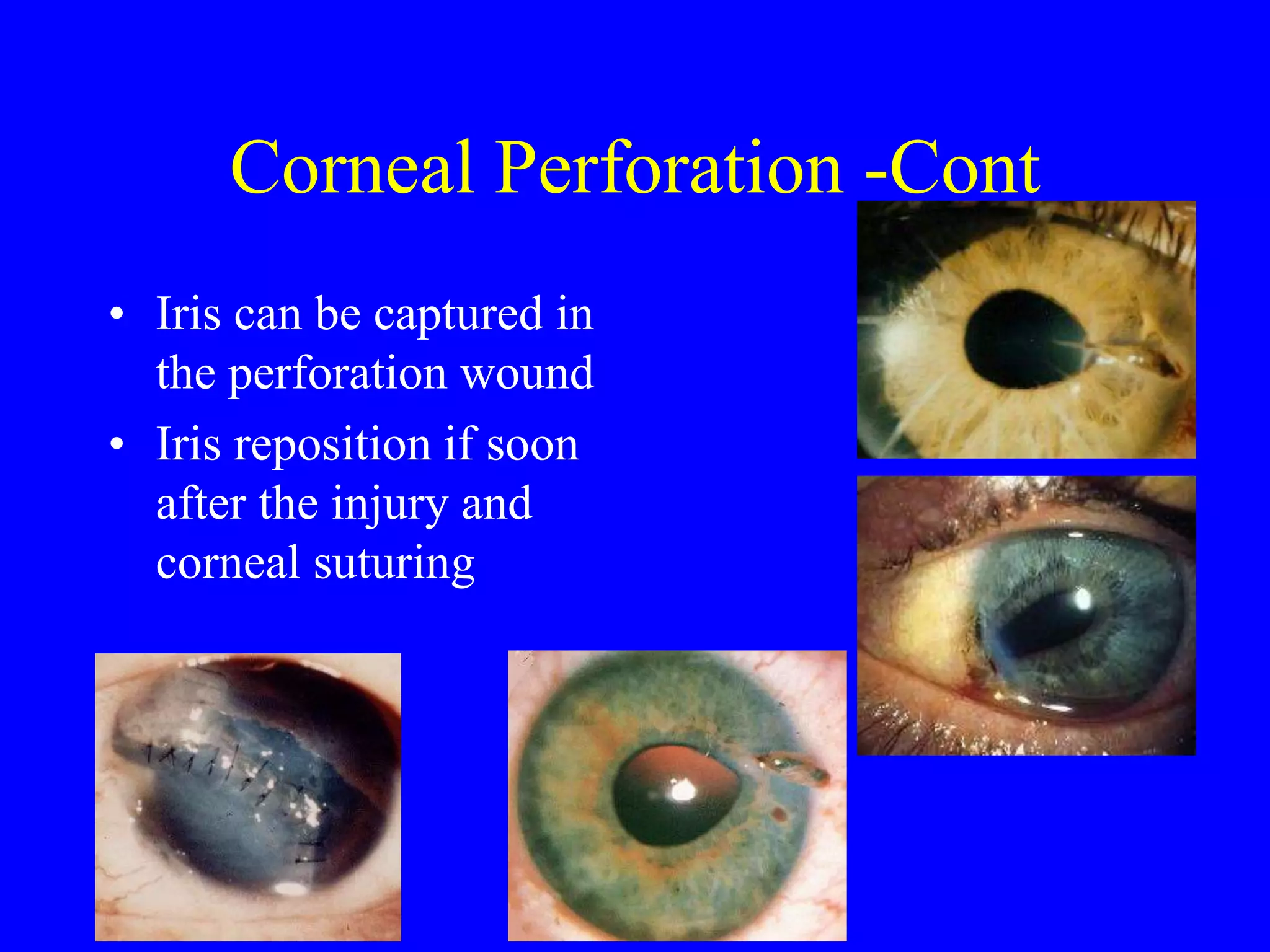 Ocular injuries- Third year mbbs Ophthalmology | PPTX