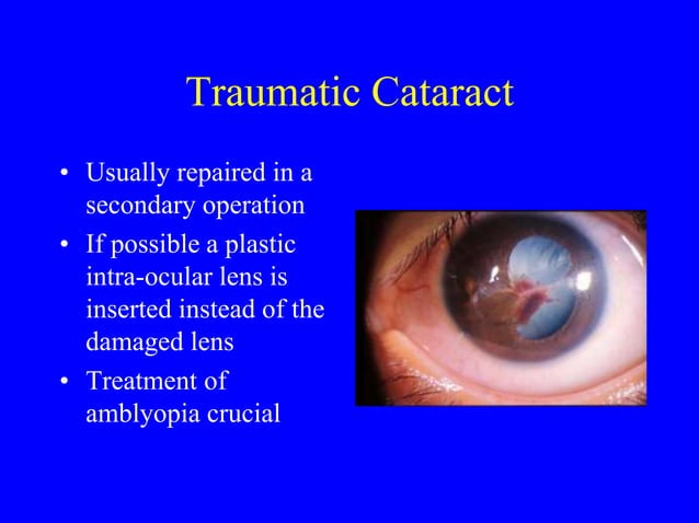 Ocular injuries- Third year mbbs Ophthalmology | PPTX | Death, Injury ...