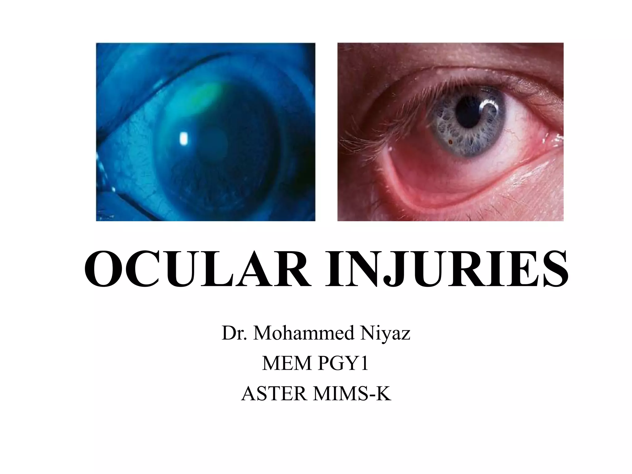 Ocular injuries | PPTX