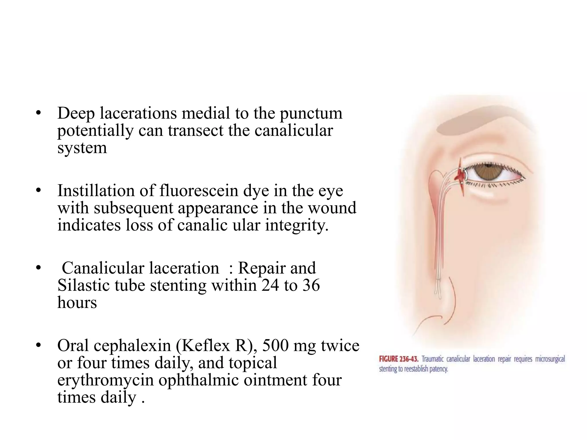 Ocular injuries | PPTX
