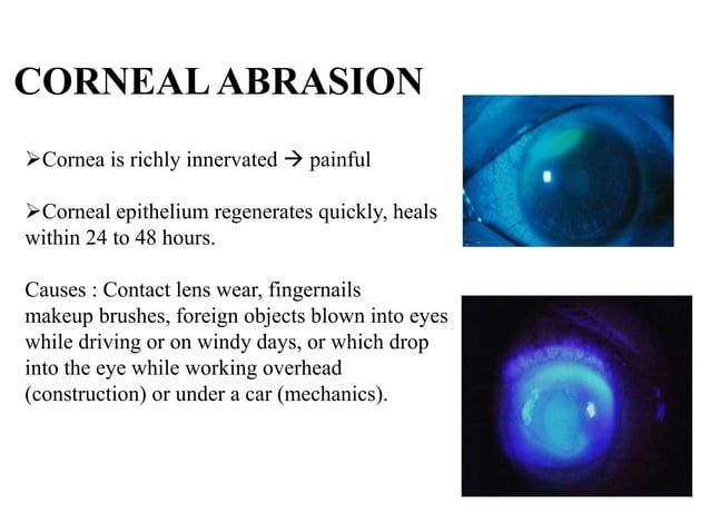 Ocular injuries | PPT | Free Download