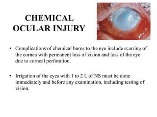 Ocular injuries | PPTX