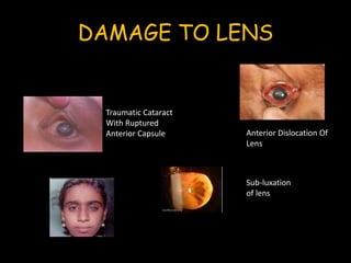 Ocular injuries | PPTX