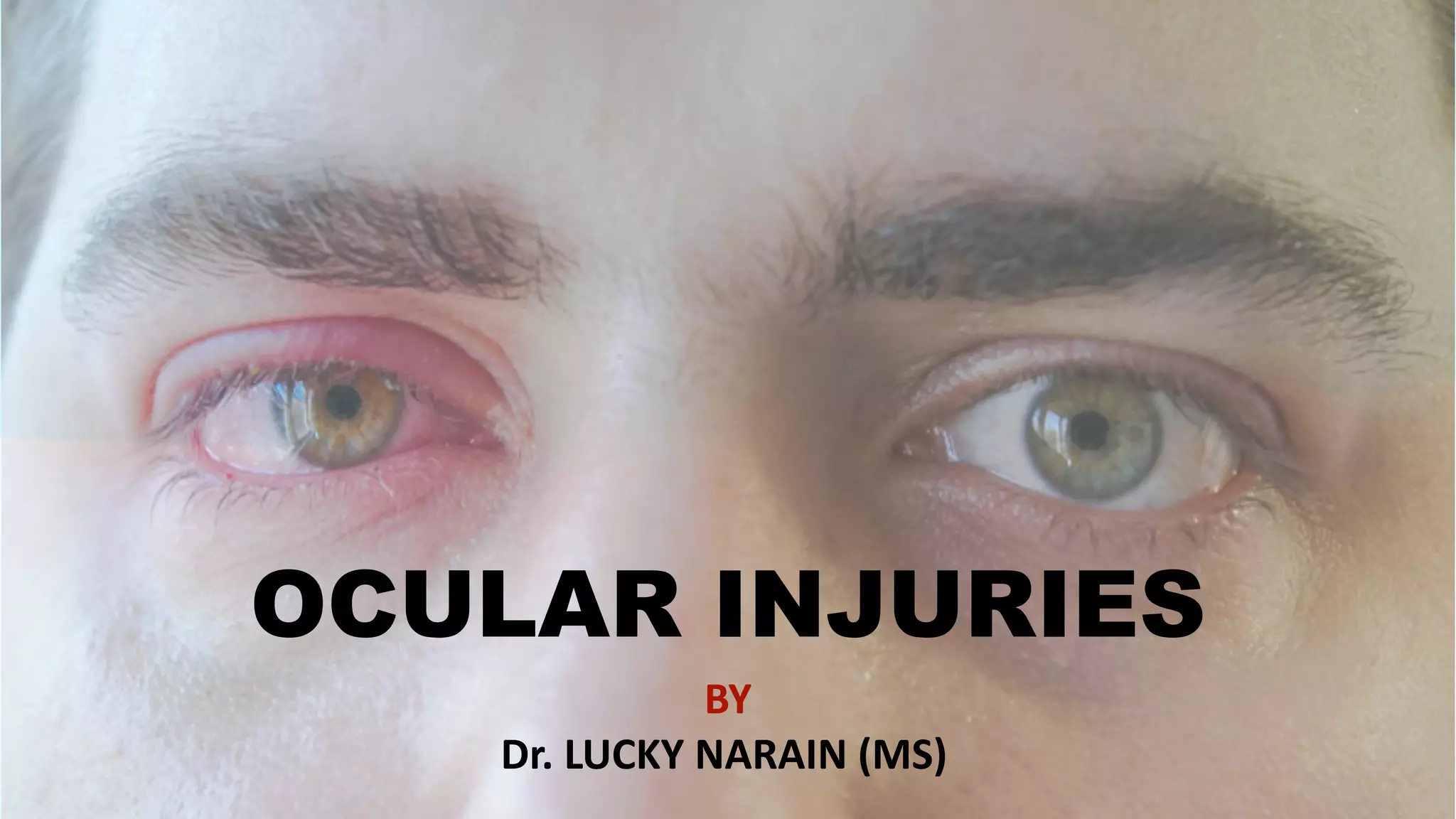 OCULAR INJURIES | PDF
