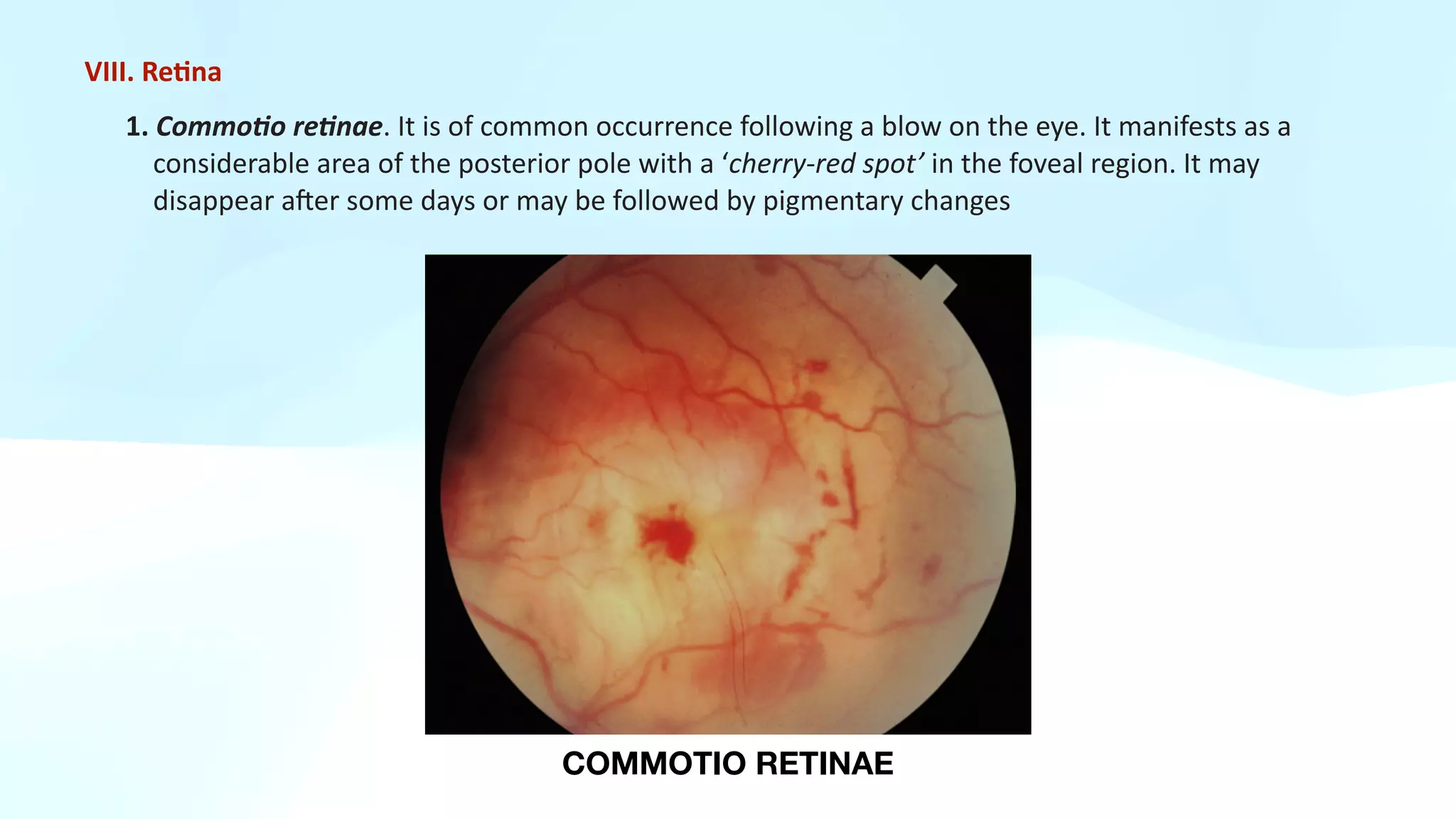 OCULAR INJURIES | PDF