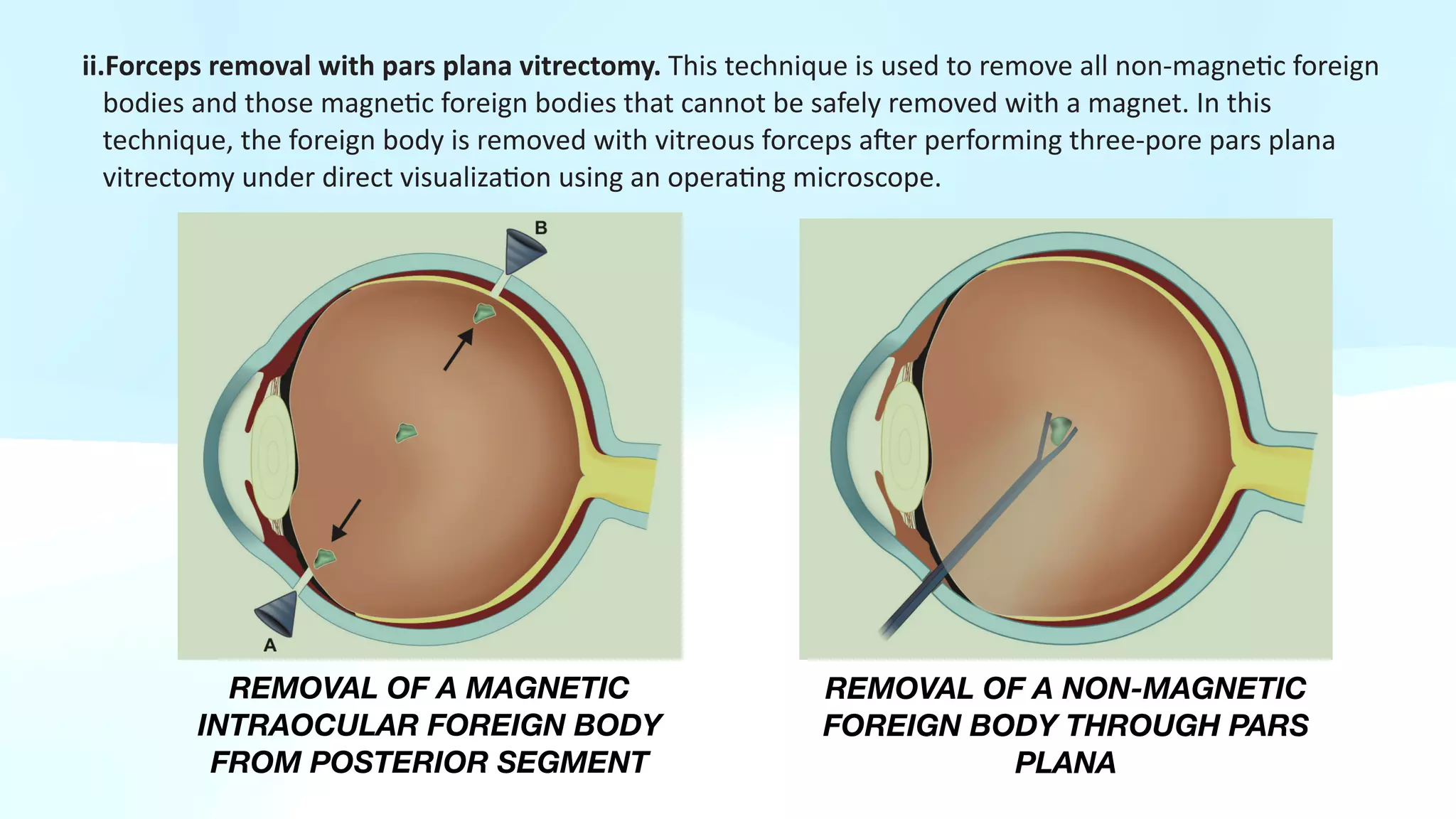 OCULAR INJURIES | PDF