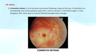 OCULAR INJURIES | PDF