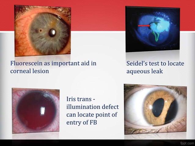 Ocular Injuries – Classification & Management Protocol.pptx | Free Download