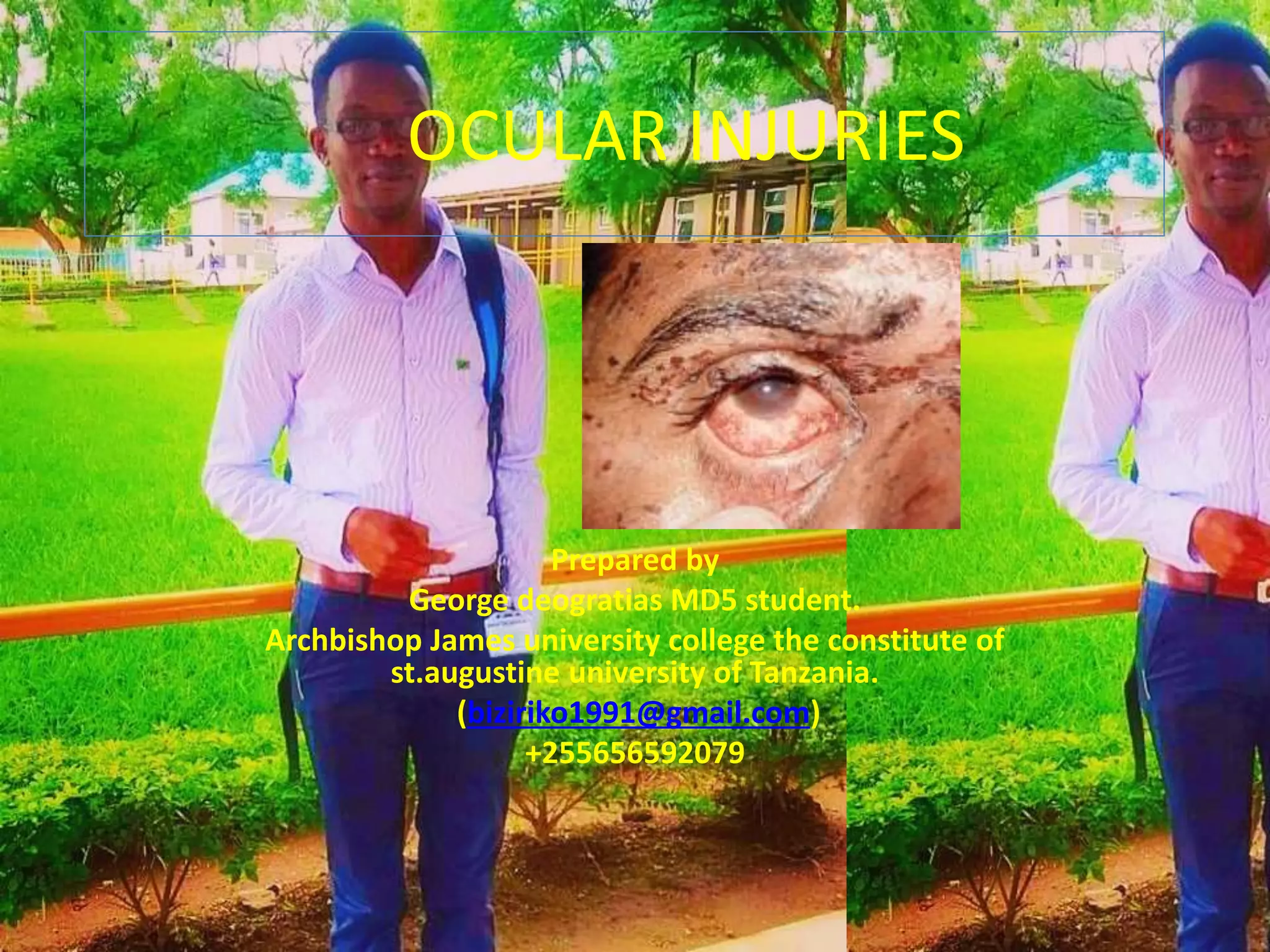 Ocular injuries new | PPT