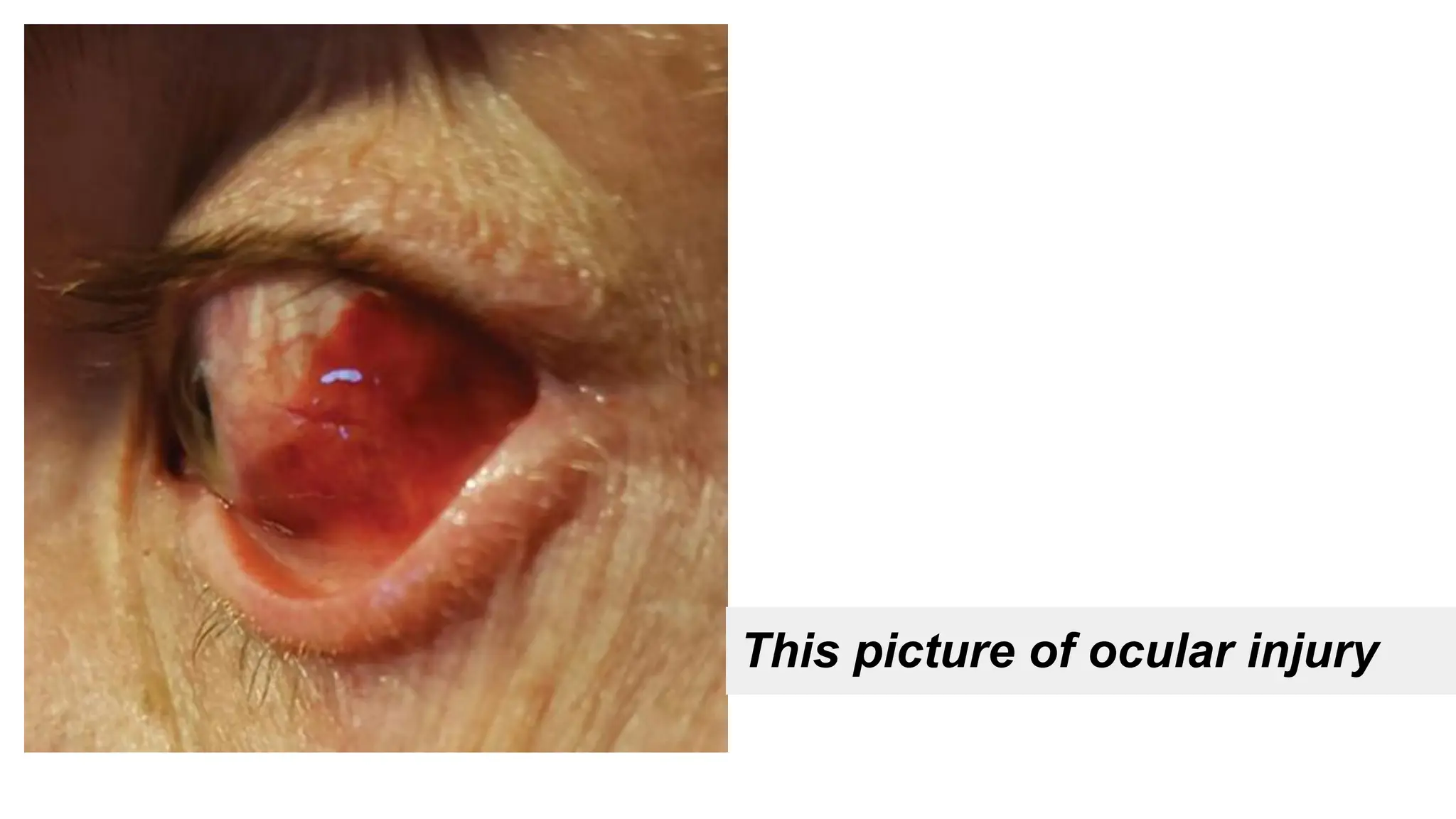 Ocular injury ppt Upendra pal optometrist upums saifai etawah | PPT