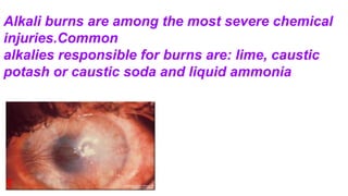Ocular injury ppt Upendra pal optometrist upums saifai etawah | PDF