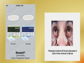 Ocular inserts | PPTX