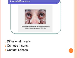 Ocular inserts | PPTX
