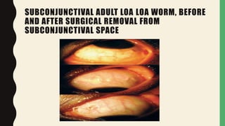 Ocular Loaloa filariasis by Dr. Iddi.pptx