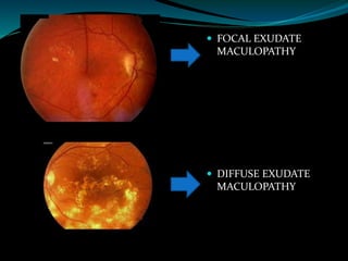 Ocular manfestations | PPTX