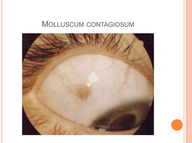 Ocular manifestation of hiv | PPTX | Eye and Vision Conditions ...