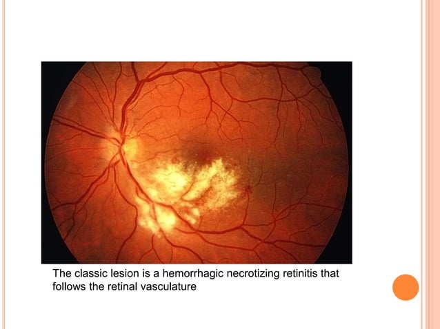 Ocular manifestation of hiv | PPTX | Eye and Vision Conditions ...