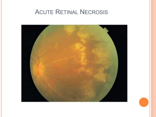 Ocular manifestation of hiv | PPTX | Eye and Vision Conditions ...
