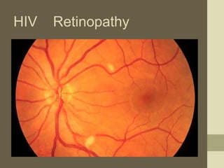 Hiv Retinopathy Oct