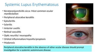 ocular manifestations of autoimmune disease.pptx